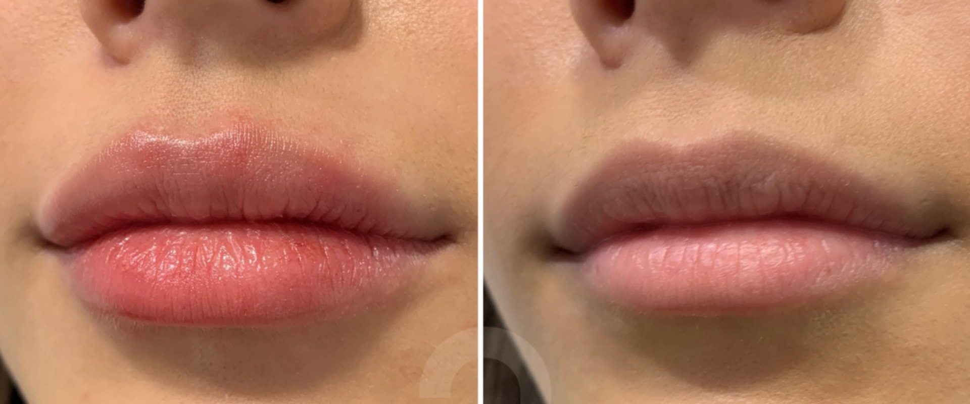 Which fillers are most likely to migrate?