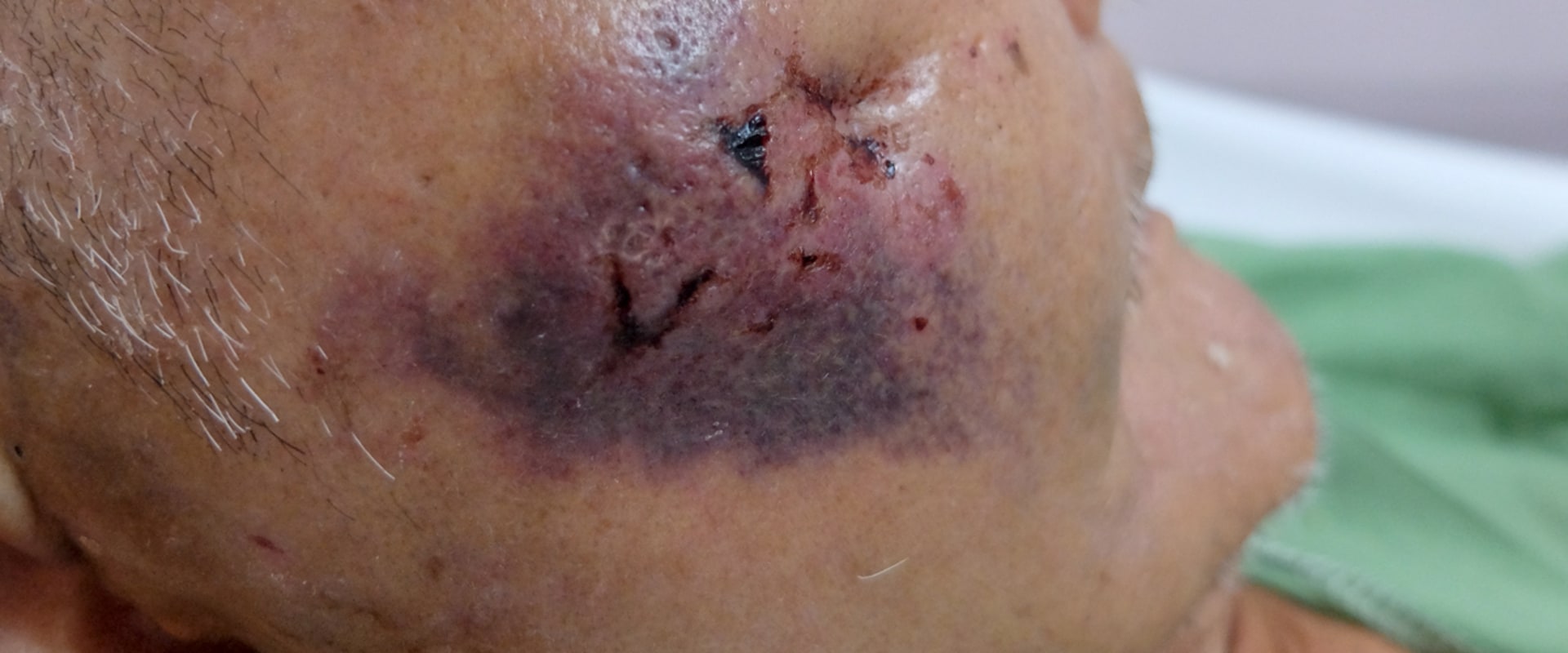 Managing Swelling and Bruising After Cosmetic Surgery