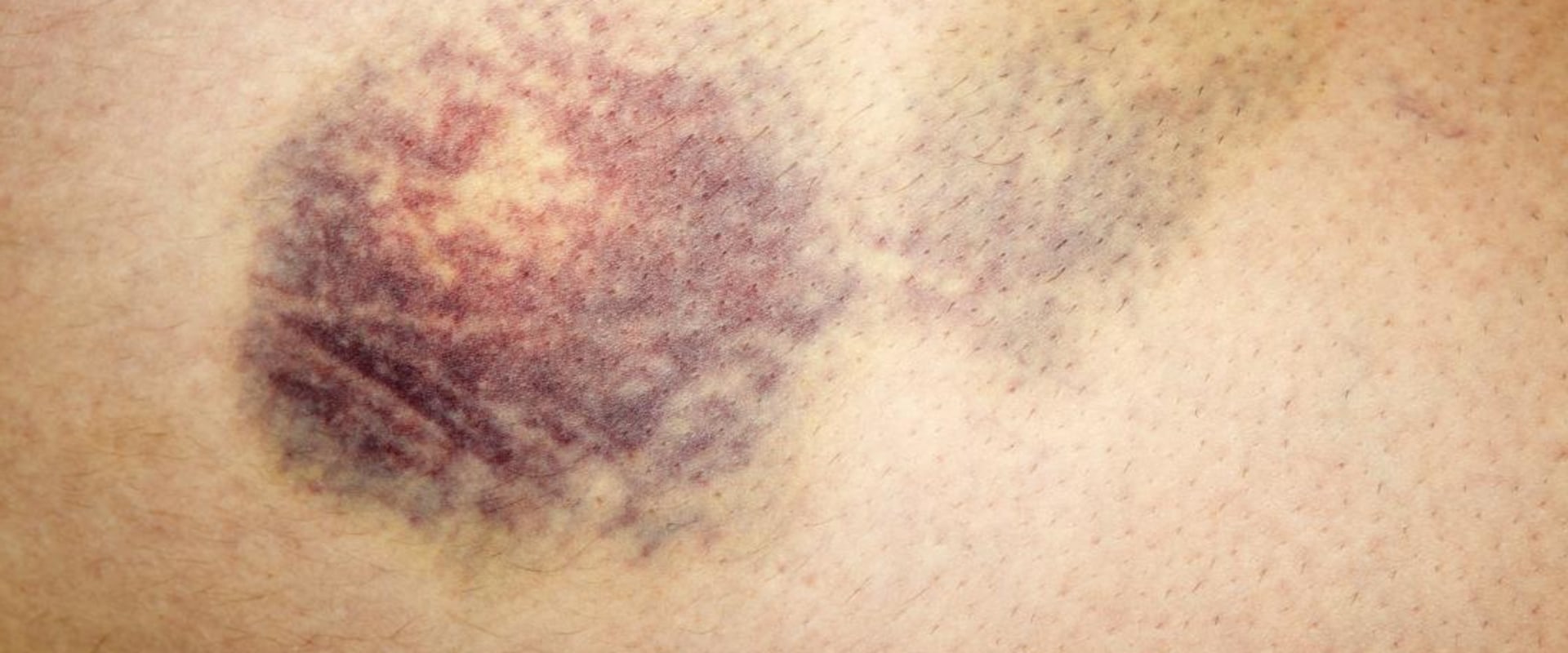 Managing Swelling and Bruising After Surgery