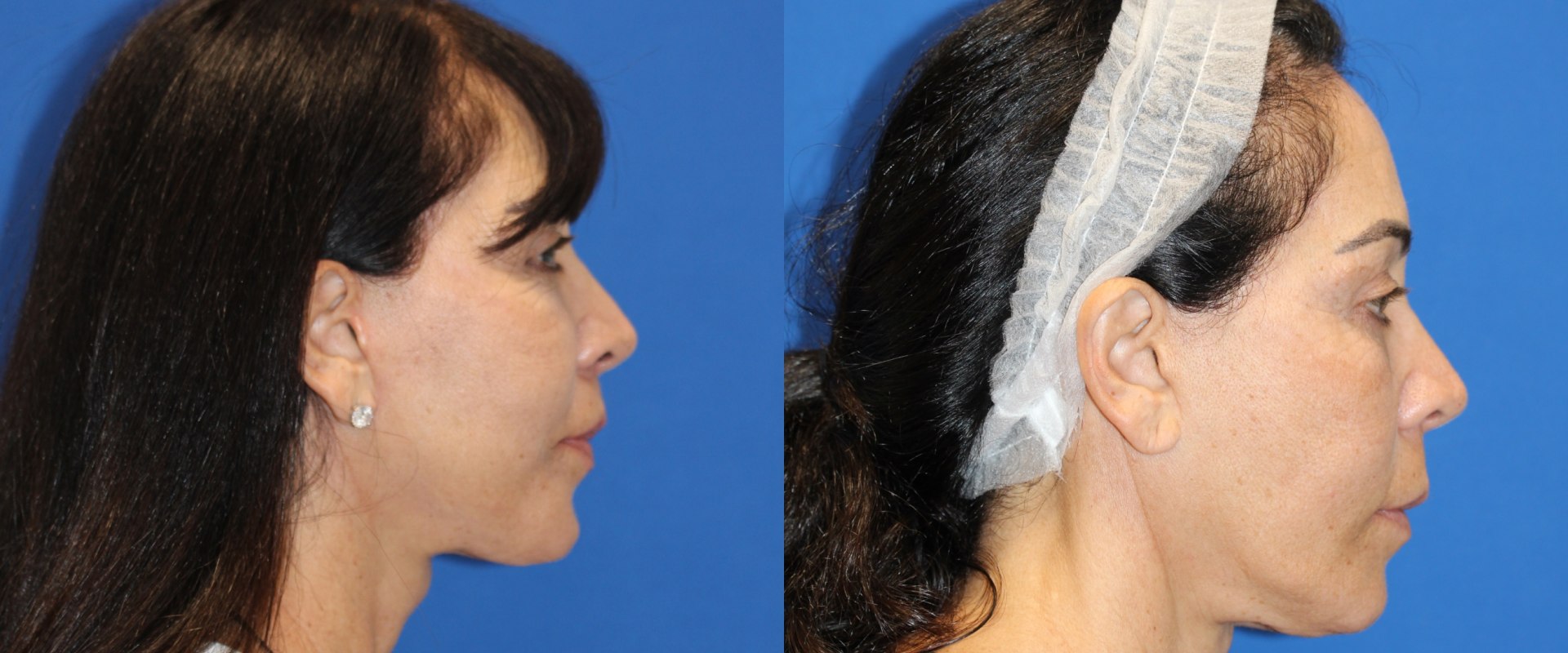 Fat Transfer: A Comprehensive Overview