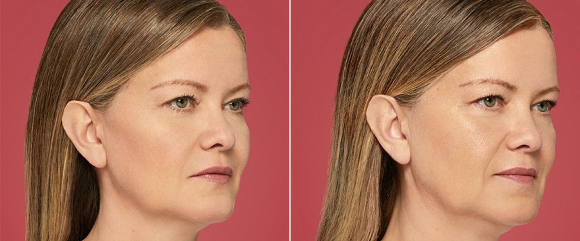 Restoration of Facial Volume and Contours: Benefits of Botox Injections