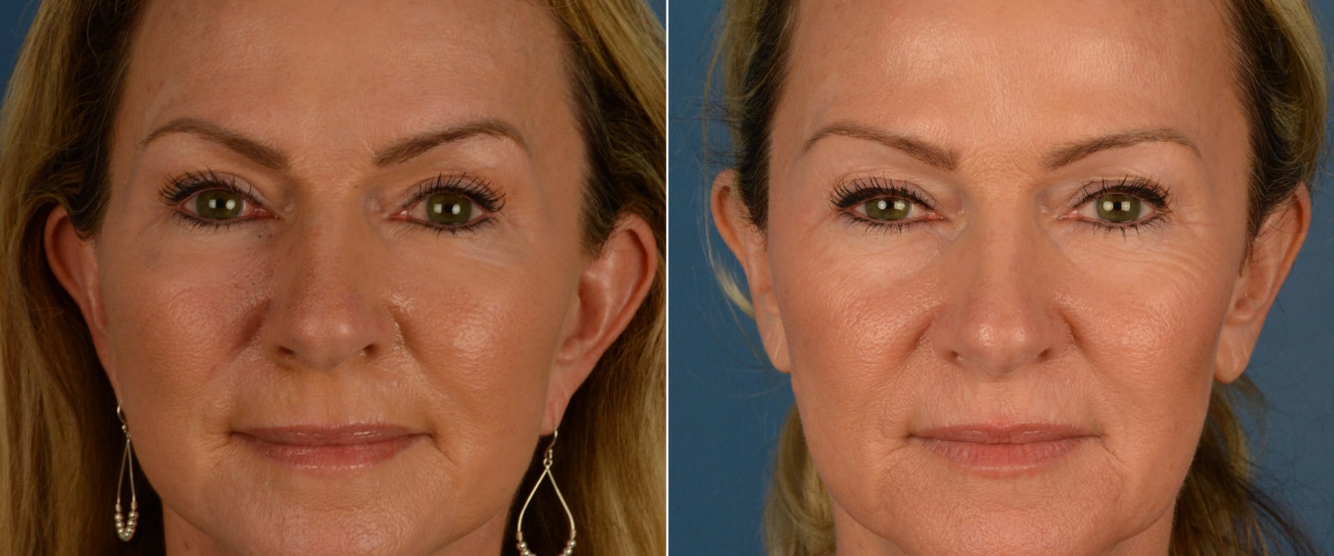 Face Lift (Rhytidectomy): All You Need To Know