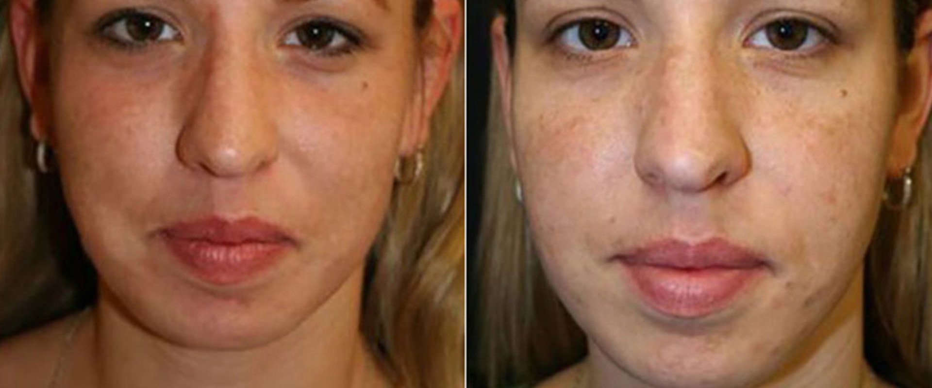 Non-Ablative Laser Resurfacing (Fraxel): A Comprehensive Overview Non-Ablative Laser Resurfacing (Fraxel): A Comprehensive Overview