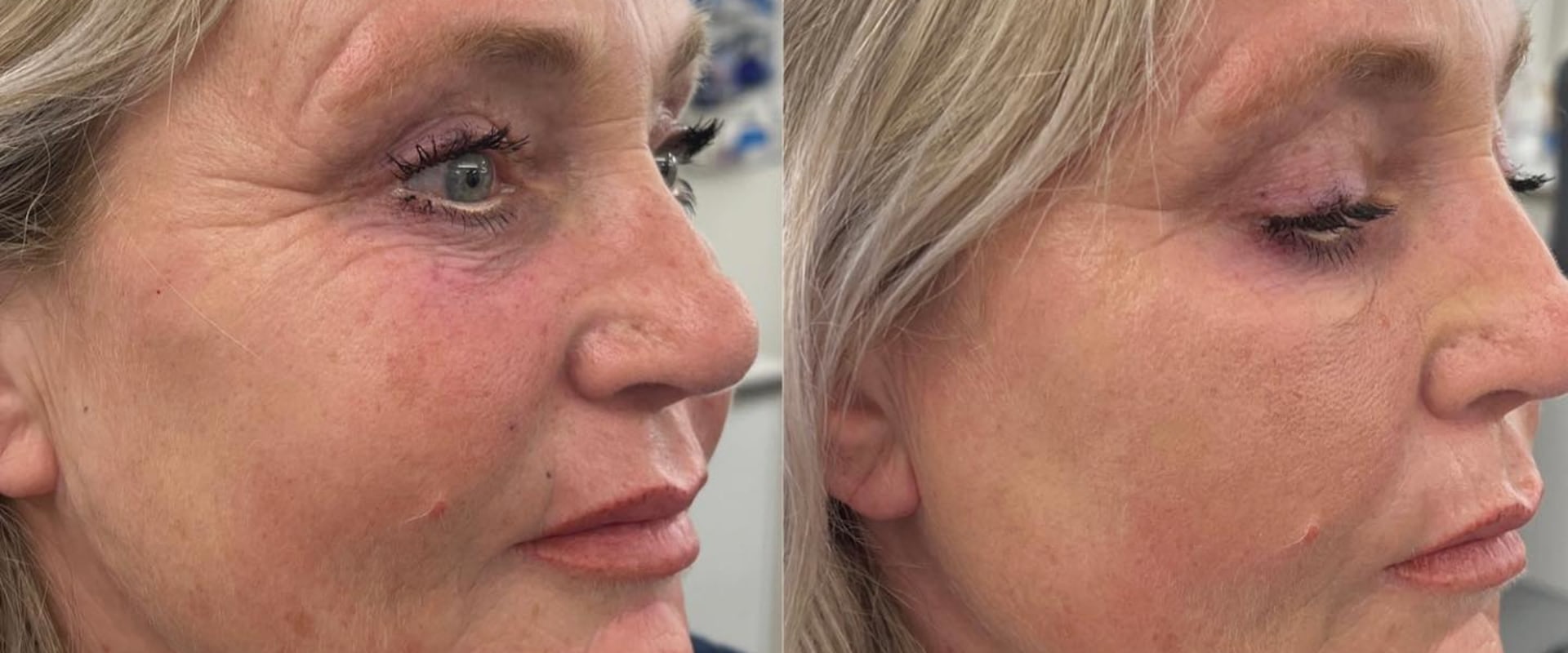 Do filler results get better over time?