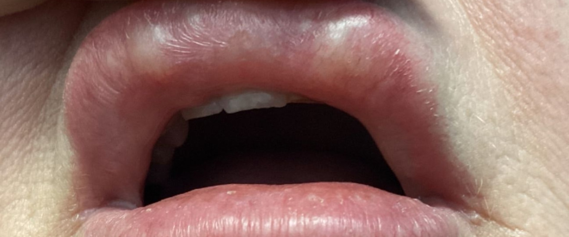 How can i get rid of a small filler nodule?